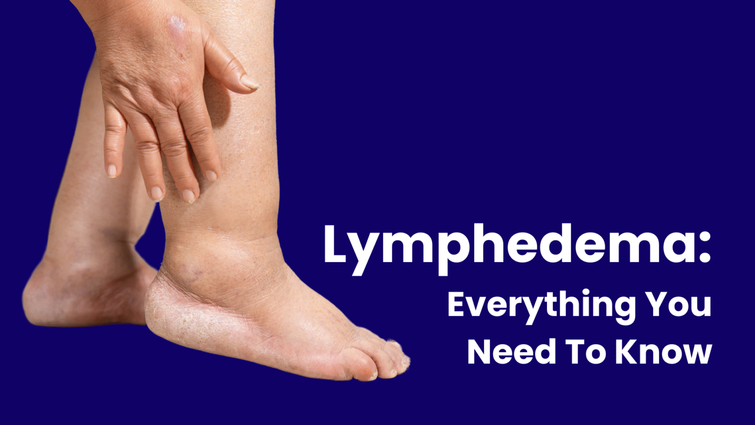 Lymphedema: Everything You Need To Know - Vein Medicine