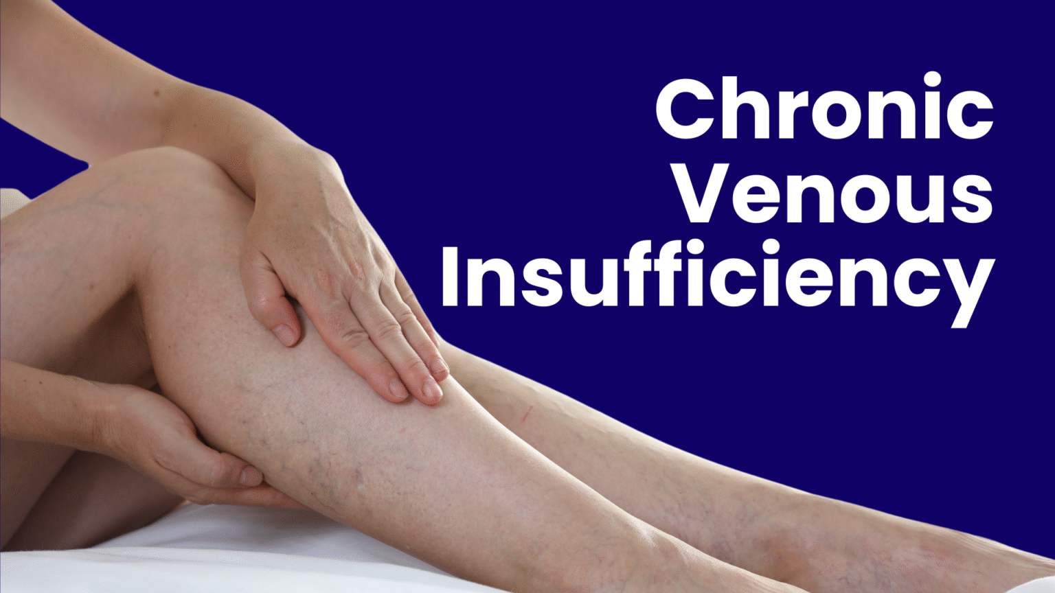 Chronic Venous Insufficiency - Vein Medicine